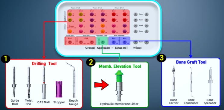[CAS KIT] #25, #26 Fixture installation Case - 영상 정리 : 네이버 블로그