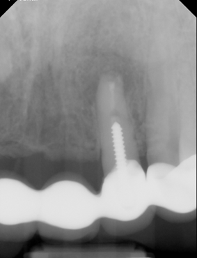 신경치료 많이 했는데도 염증이 재발해요. 발치는 싫어요. 미세치근단 수술, Apical microsurgery ...