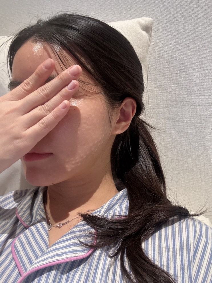 리쥬란 HB 2cc + 스킨보톡스 내돈내산 후기 1일차, 2일차, 3일차 (feat. 엠보, 통증 그리고 효과까지) : 네이버 블로그