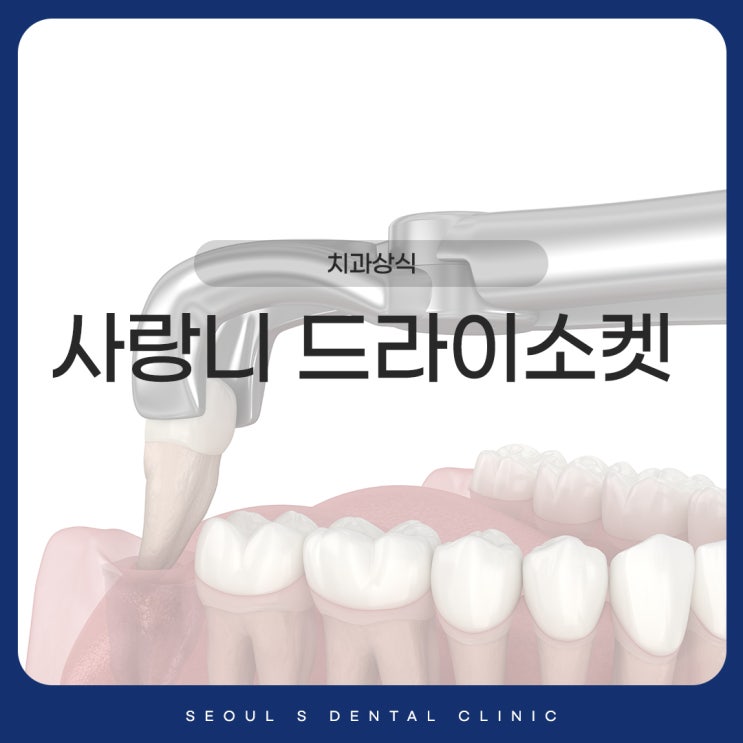 사랑니 드라이소켓 예방하려면 어떻게? : 네이버 블로그