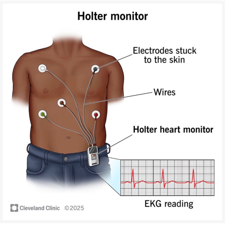 24시간 홀터 검사 (Holter Monitor) vs Telemetry 심전도 검사 공부하기 : 네이버 블로그