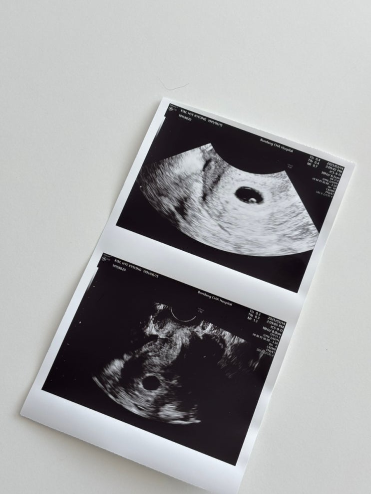 30대 초반, Amh 수치 0.8 극난저 자연임신 성공한 영양제 정리(+섭취 시간) 🙏🏻 : 네이버 블로그