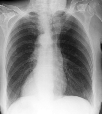 Case Study_941:대동맥궁 역위증(Situs inversus)-희귀하지만 중요한 선천성 질환의 이해 : 네이버 블로그