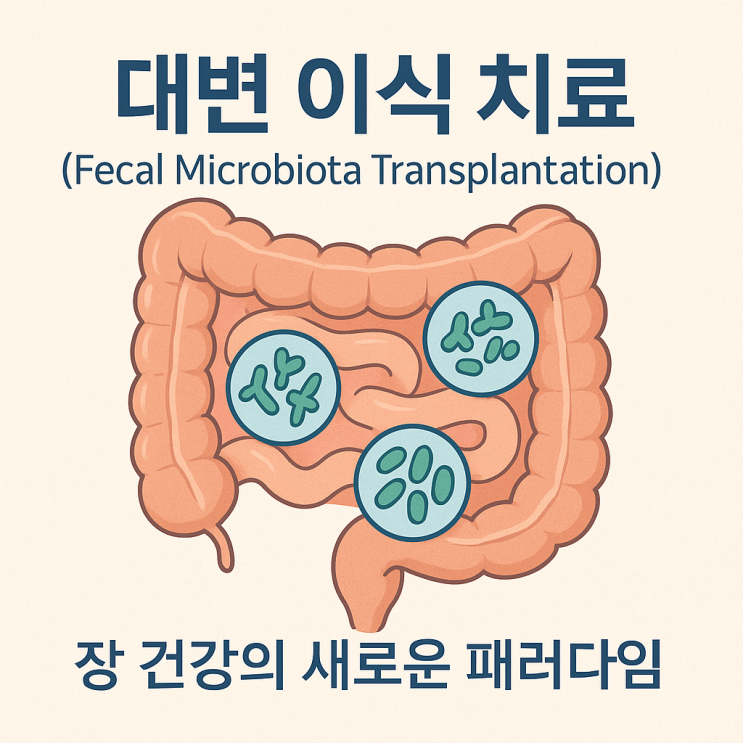 대변 이식 치료(Fecal Microbiota Transplantation) : 장 건강의 새로운 패러다임 : 네이버 블로그