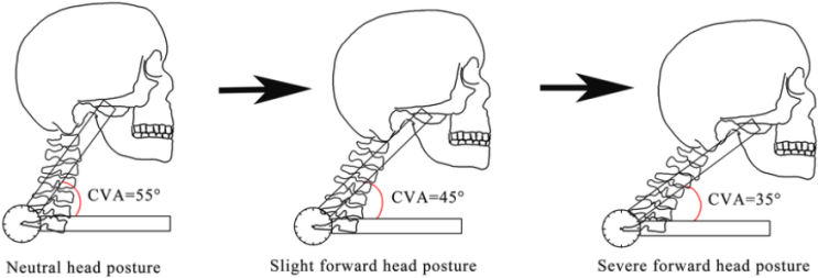 Craniovertebral angle(CVA) : 네이버 블로그