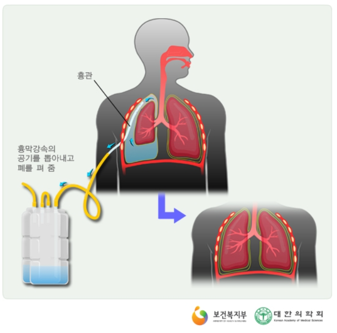 CTD(Chest tube drainage)의 모든 것, CTD 간호 : 네이버 블로그