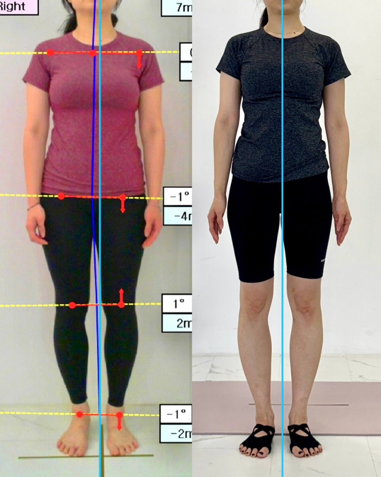 [SNPE 부산][부산 SNPE] SNPE부산대점 예비신부 어깨라인, 허리, 골반라인 자세 비포애프터 : 네이버 블로그