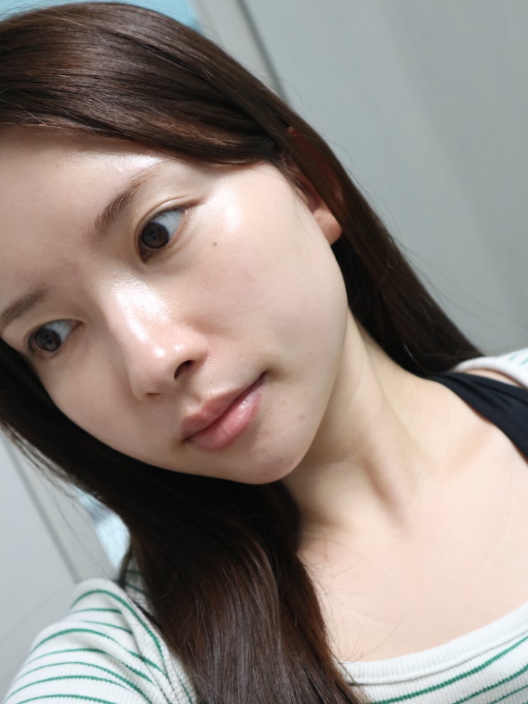 부산피부과 브이빔퍼펙타로 홍조 잡은 후기 : 네이버 블로그