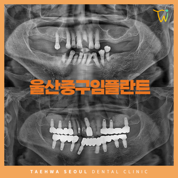울산중구임플란트, 정밀한 계획이 만드는 편한 저작감 : 네이버 블로그