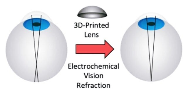 라식수술 필요 없다…1분 만에 시력 교정하는 기술 개발 No LASIK Needed… New Technology Corrects ...