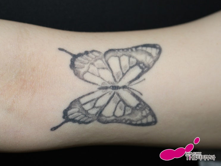 팔 미니타투제거 엠타트(M-Tat®) 4회차 시술 종료 ::: 부천 더 피부과 문신제거클리닉 : 네이버 블로그