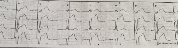 [Study] Temporary pacemaker(TPM)_실무 문제발생 시 대처방안(Capture failure ...