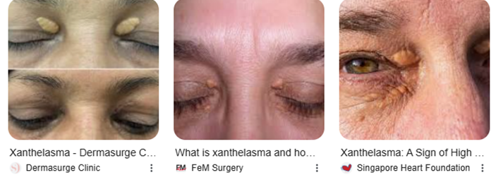 담석과 눈 주위 노란 주머니,잔텔라마(Xanthelasma) : 네이버 블로그