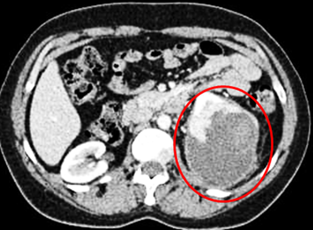 Case Study_1014:옆구리 통증과 혈변을 보는 41세 여성-피막하 콩팥주위 혈종(Subcapsular perirenal ...