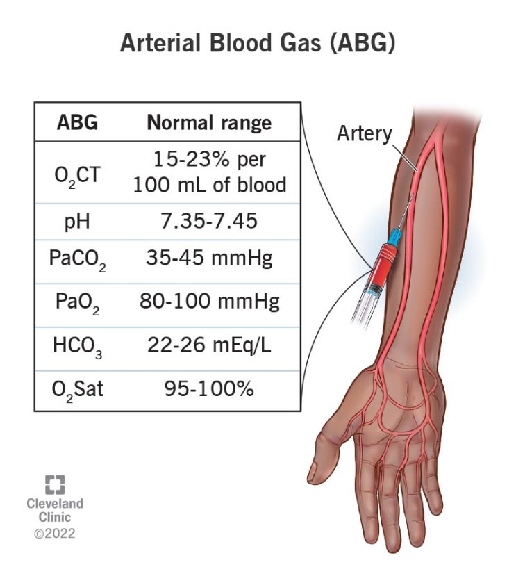 💉 동맥혈가스검사(ABGA) 완전 해부! 의료진부터 일반인까지 꼭 알아야 할 검사방법과 해석법 총정리 : 네이버 블로그