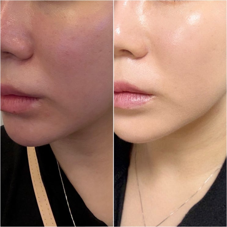 부평역피부과 스킨부스터 물광주사 내돈내산 통증 전후 후기 : 네이버 블로그