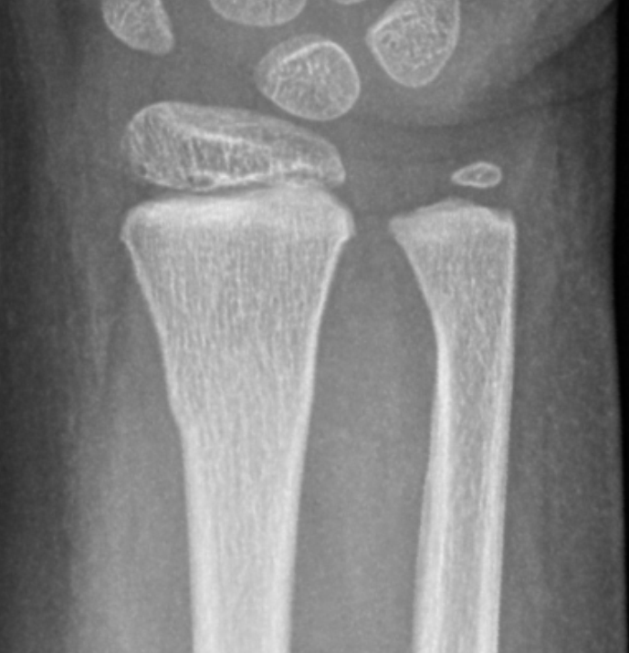 그린스틱 골절(Greenstick fracture) : 네이버 블로그