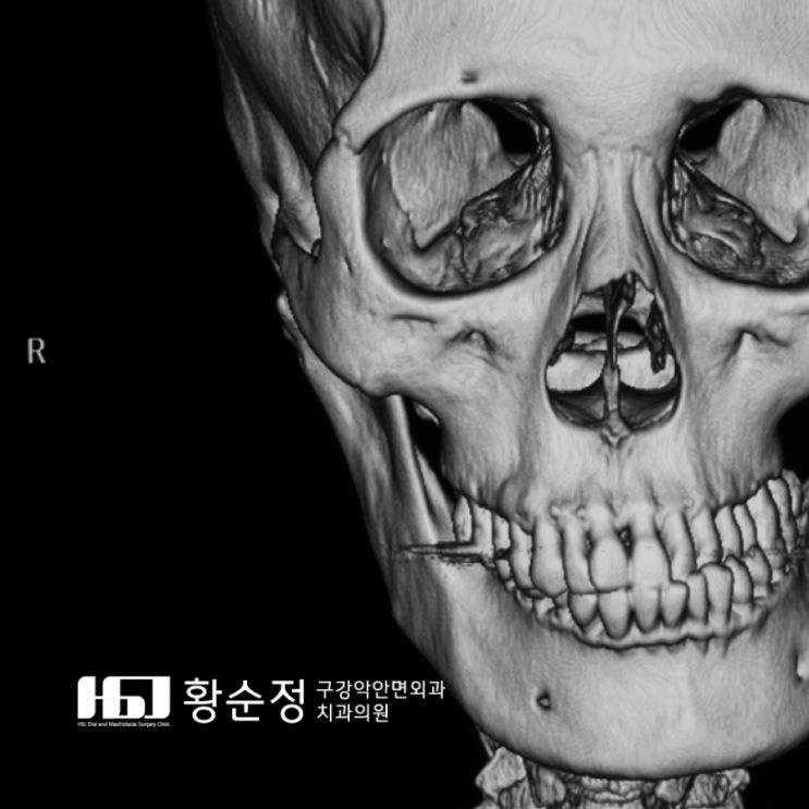 안면 비대칭 교정을 위한 BSSRO에서 과두(Condylar) 회전을 최소화하는 후방 굴곡 골절술 후 과두 위치 변화 : 네이버 블로그