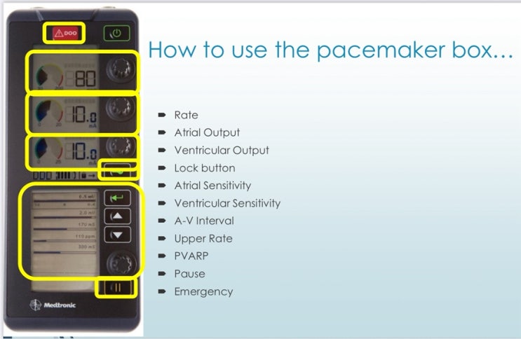 Pacemaker mode (TPM, PPM 의학용어) 공부하기 : 네이버 블로그