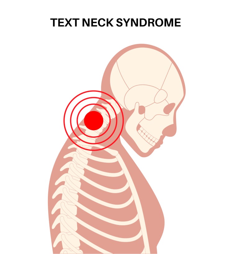 [메디핏짐] Forward head posture ; Turtle neck syndrome 거북목 증후군 : 네이버 블로그