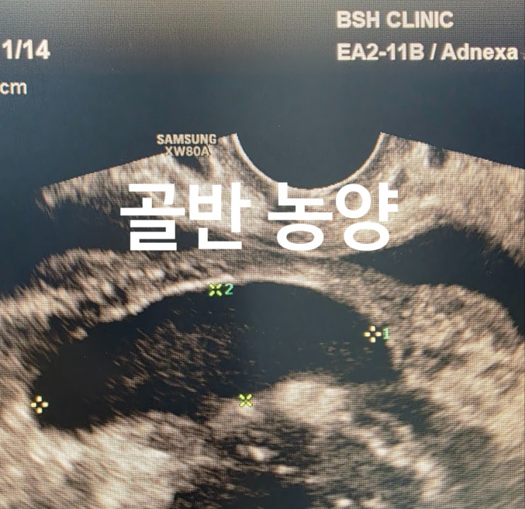 : 제왕절개 이후 골반에 발생한 농양 (Pelvic Abscess) : 네이버 블로그