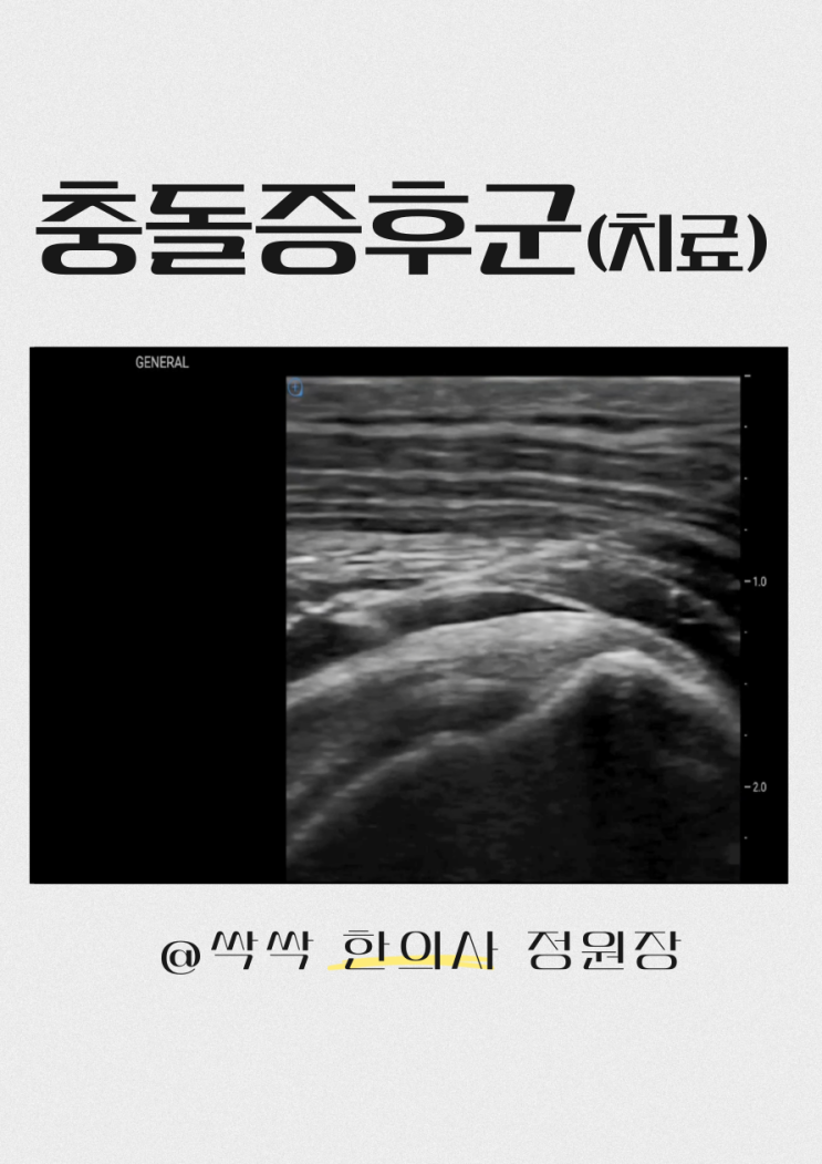 팔을 들 때 어깨가 아파요(2)-충돌증후군 치료 : 네이버 블로그