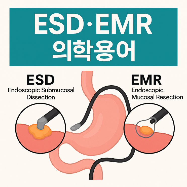 의학용어 ESD, EMR에 대해서 알아보기 : 네이버 블로그