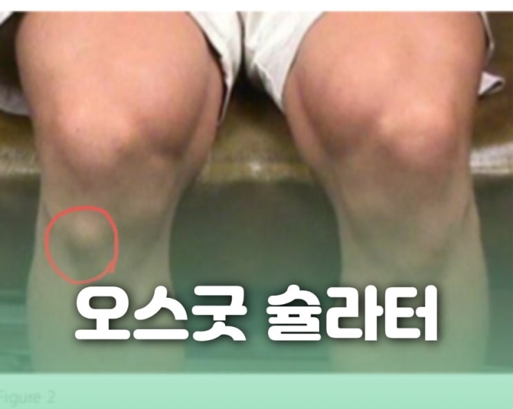 당산PT 성장기 무릎통증, 오스굿-슐라터 질환(Osgood Schlatter Disease) : 네이버 블로그