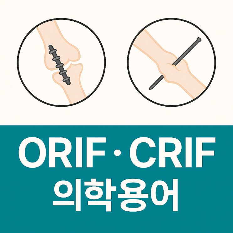 의학용어 ORIF, CRIF에 대해서 알아보기 : 네이버 블로그