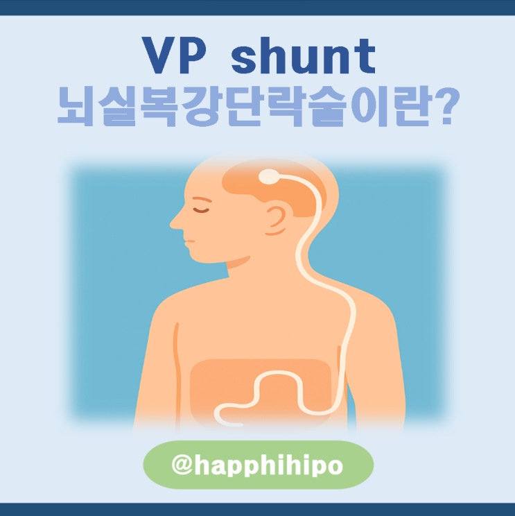 VP shunt(뇌실복강단락술)이란? 션트 수술 뜻, OP, 수술, 방법, 적응증, 제거, 부작용, 압력 조절, MRI, 주의 ...