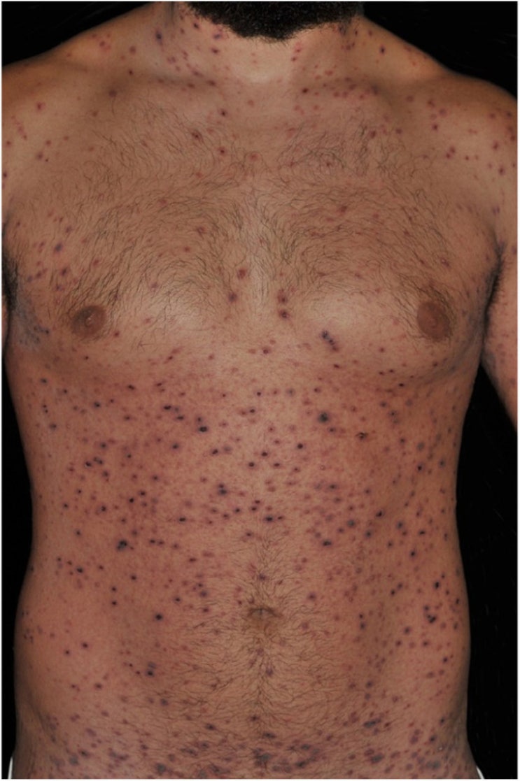태선양 비강진(Pityriasis Lichenoides): 급성(PLEVA)과 만성(PLC)의 두 얼굴 : 네이버 블로그