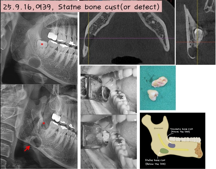“Stafne bone cyst(Defect)란? – 39세 환자 사례와 사랑니 발치”(25.9.16,화) : 네이버 블로그