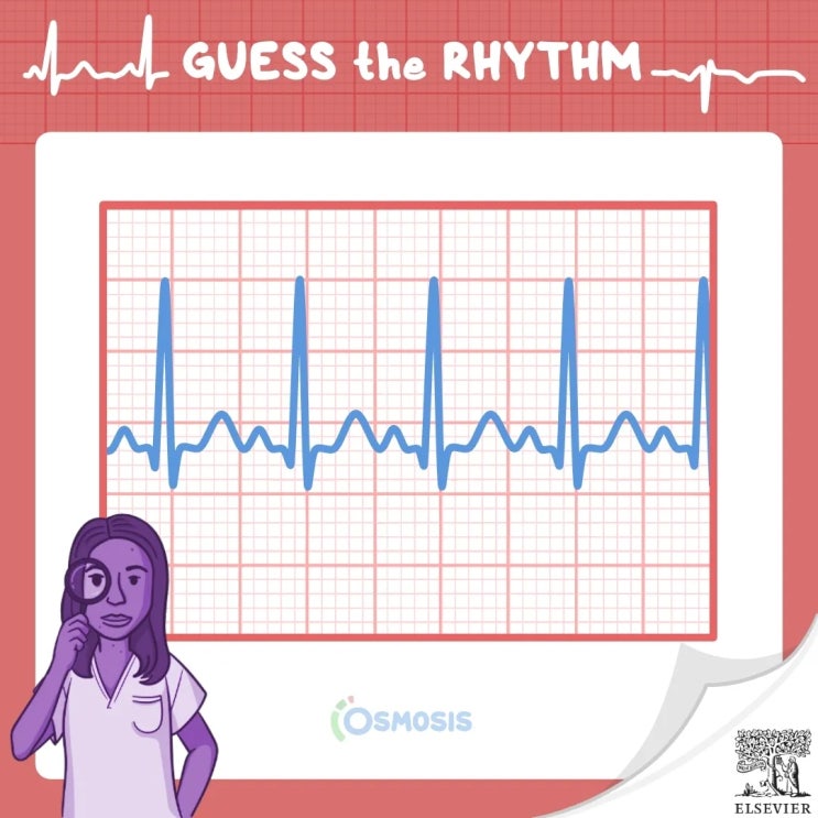 Guess the Rhythm: Sinus tachycardia : 네이버 블로그