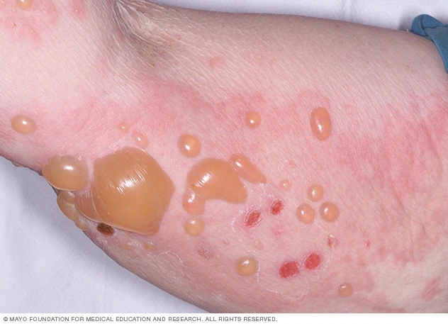 유사천포창(Bullous Pemphigoid): 원인부터 최신 치료법까지 총정리 : 네이버 블로그