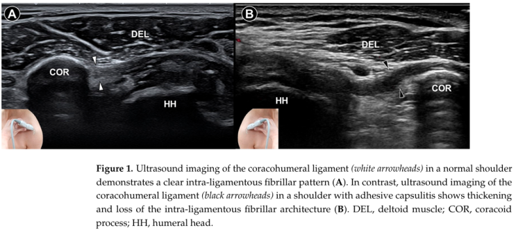 MSKUS approach to Adhesive capsulitis : 네이버 블로그