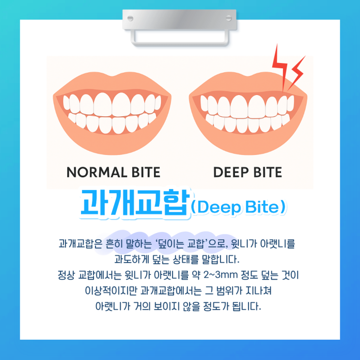 대전치과, 🦷 과개교합(Deep Bite), 그냥 두면 어떤 문제가 생길까요? : 네이버 블로그