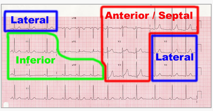 EKG of myocardial infarction :: 12-lead Anatomic groups : 네이버 블로그