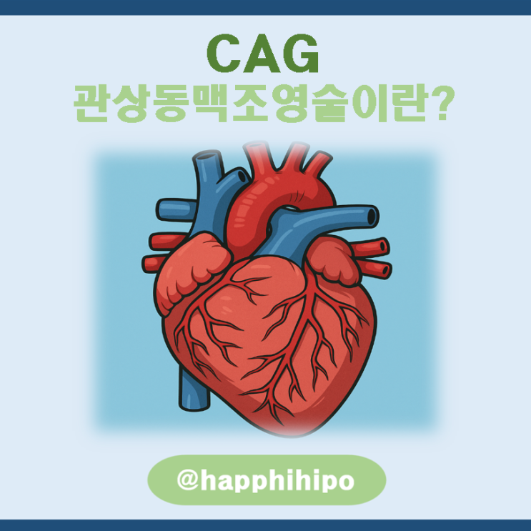 의학용어 CAG(관상동맥조영술)이란? 관상동맥 위치, 검사, 방법, 간호, CAG PCI, 스텐트, 비용, 보험 총정리 ...