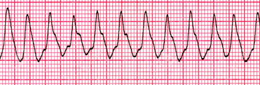 syncronized cardioversion(심율동전환)과 defibrilation(제세동)차이 : 네이버 블로그