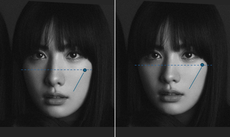 중안면(중안부) 긴얼굴, 앞광대 볼륨이 핵심, 긴 얼굴, 긴 턱 안면 윤곽 성형(5-4) The Role of Volume in ...