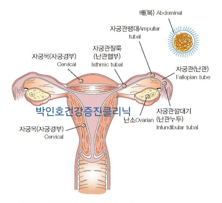 인체병리학 🔴249 생식계통 임신 분만 1 자연유산 자궁외임신 임신고혈압 전자간증 And 자간증 네이버 블로그