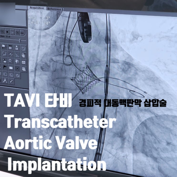 TAVI(Transcatheter Aortic Valve Implantation) 타비마취준비 : 네이버 블로그