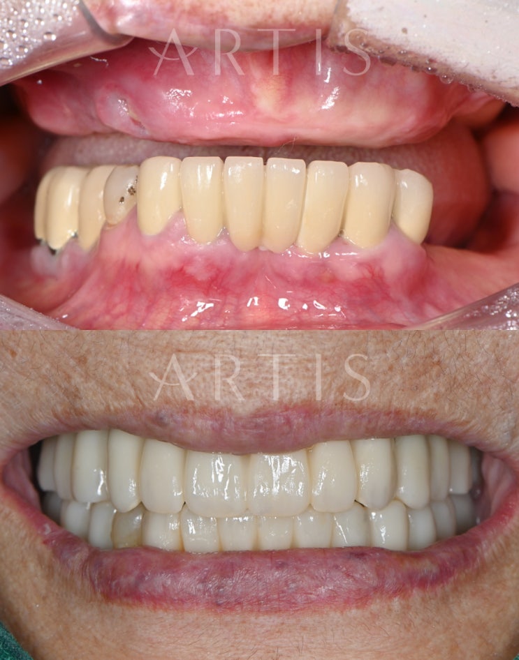 상왕십리치과 10년 틀니 쓰신 분 임플란트 20개 해드렸어요 : 네이버 블로그