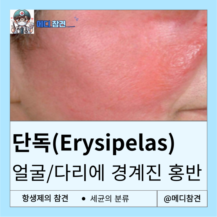 A군 연쇄상구균 Streptococcus pyogenes Erysipelas : 네이버 블로그