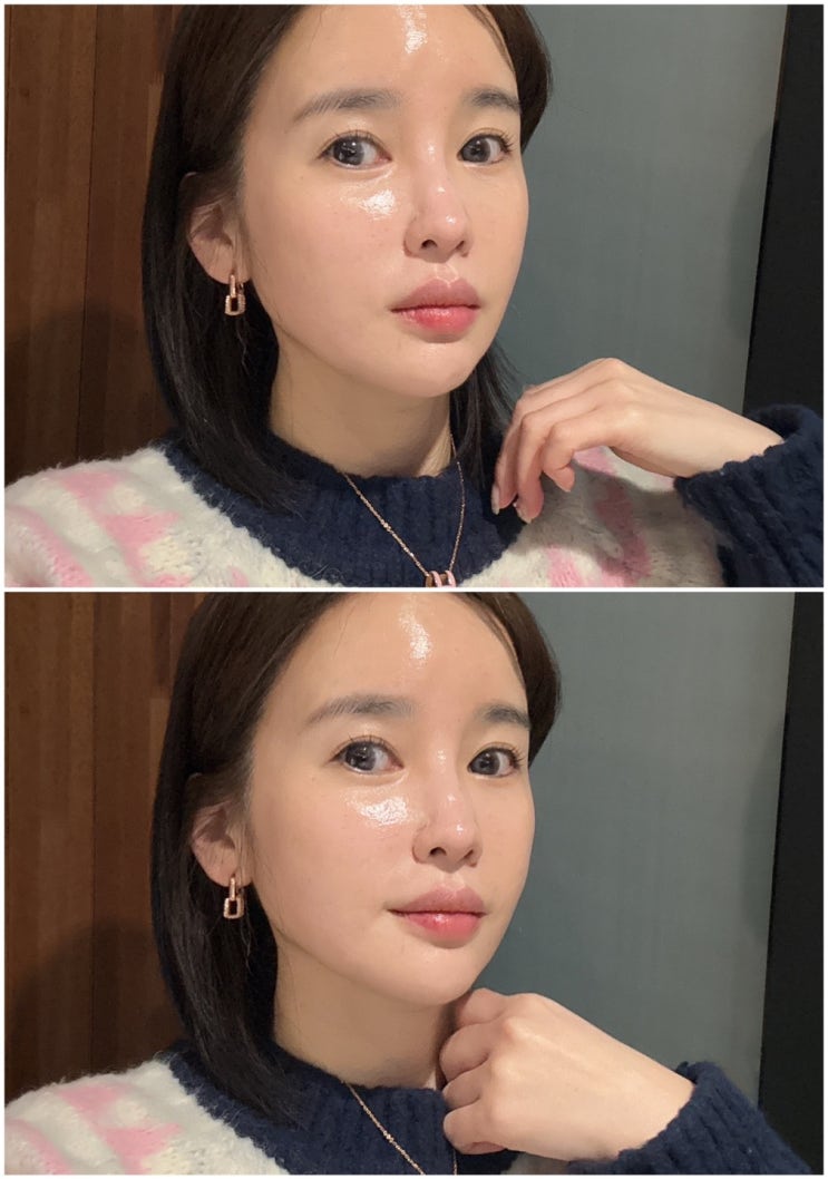 부산 경성대 대연동 스킨부스터 비타란 주사 내돈내산 후기 : 네이버 블로그