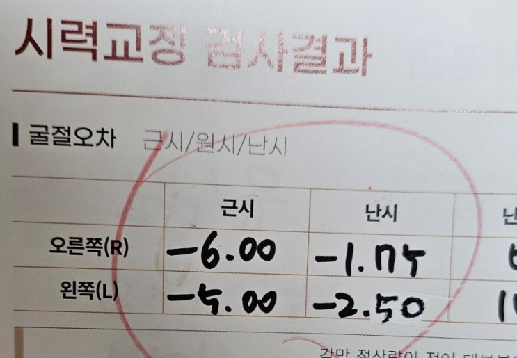 대구 누네안과병원 라식 후기 : 네이버 블로그