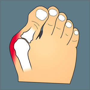 hallux vaguls chevron osteotomy 무지 외반증 수술 가이드 : 네이버 블로그