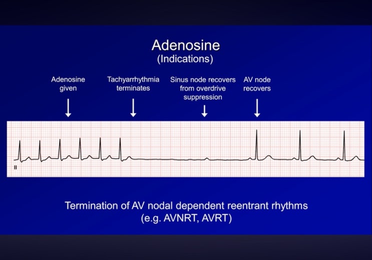 아데노신주 Adenosine 아데노코 약물 효과, 작용 기전 vs Amiodarone 아미오다론 차이 : 네이버 블로그