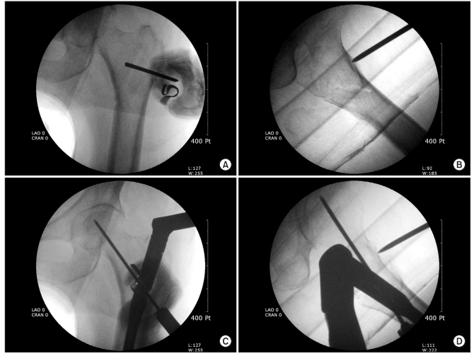 [정형외과 전문의] 근위대퇴골절의 PFNA 수술 (ORIF c PFNA. Femur intertrochanteric ...