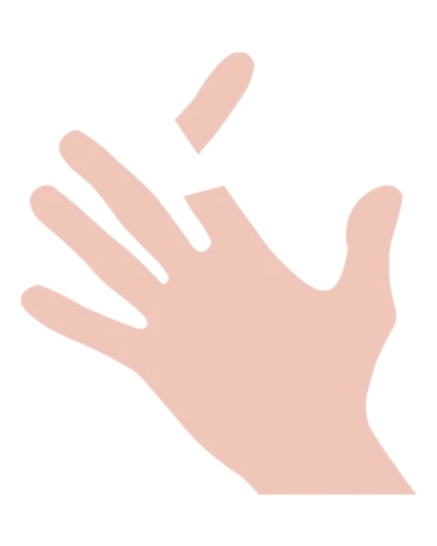 손 외상 - 손가락 절단 : 손가락의 부분 절단 partial finger amputation : 네이버 블로그